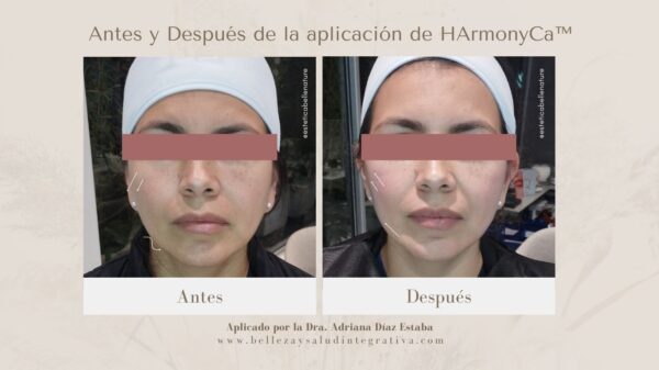 ¿Qué es HArmonyCa y cuáles son sus beneficios para la piel? - bellezaysaludintegrativa.com